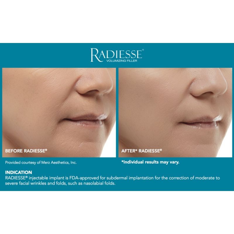 SALE RADIESSE RADIESSE (1x3ml) MERZ IN FRANCE | FRANCE-HEALTH