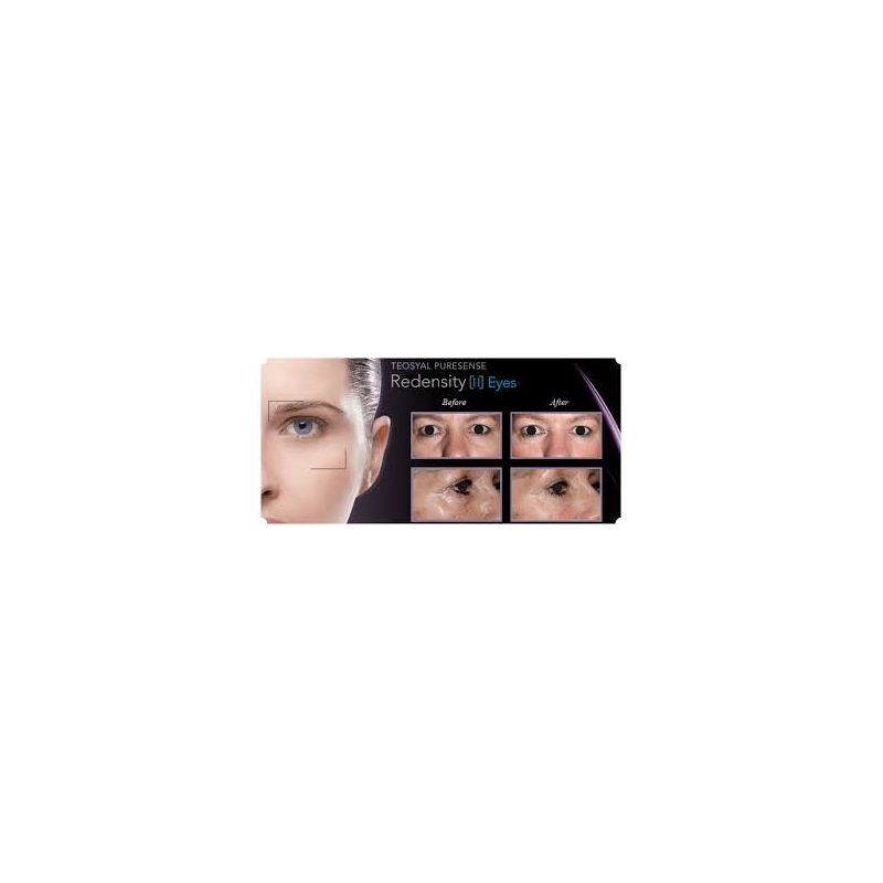 COMPRAR TEOSYAL REDENSITY [II] | Tratamiento de ojeras bajo los ojos