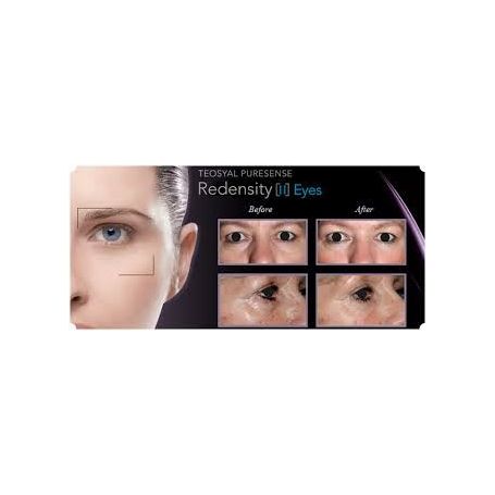 BUY TEOSYAL REDENSITY [II] | Treatment of dark circles under the eyes