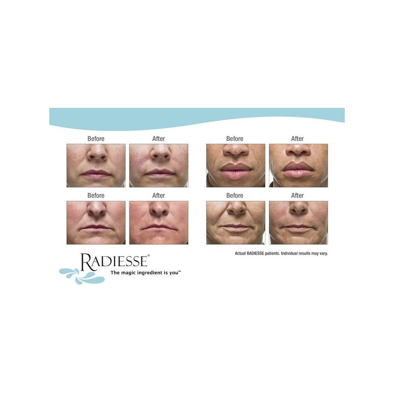 BATCH OF 10 RADIESSE (1x1,5ml) MERZ