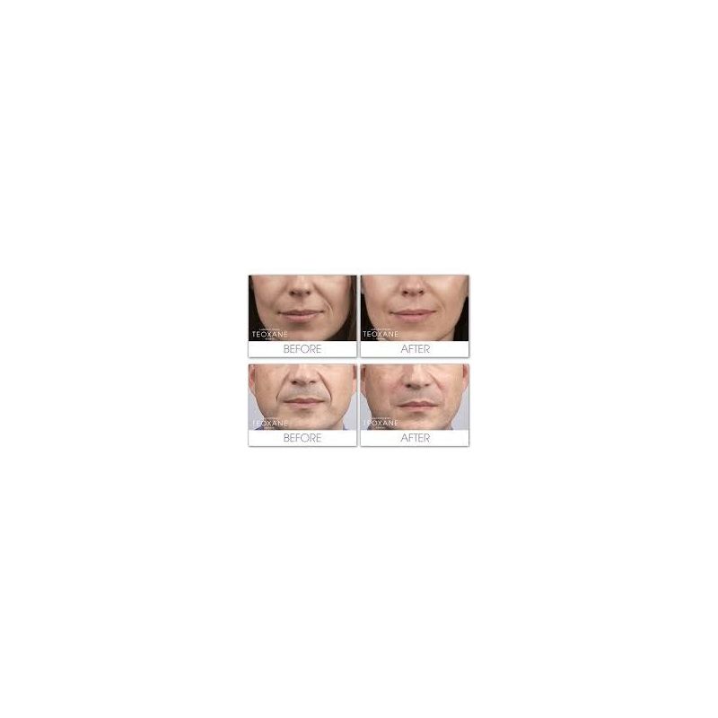 BUY TEOSYAL Puresense ULTRA DEEP (2x1.2ml) in FRANCE | FACE VOLUMATOR