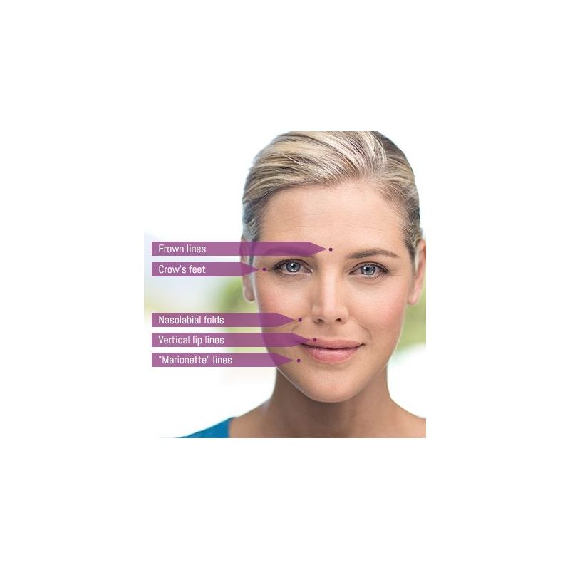 BUY JUVEDERM VOLUMA Aesthetic injection: cheekbones, cheeks, chin, jaw