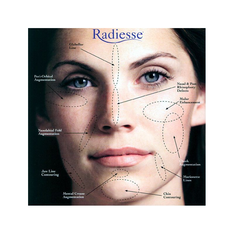 SALE RADIESSE LIDO (1x1,5ml) MERZ IN FRANCE | FRANCE-HEALTH