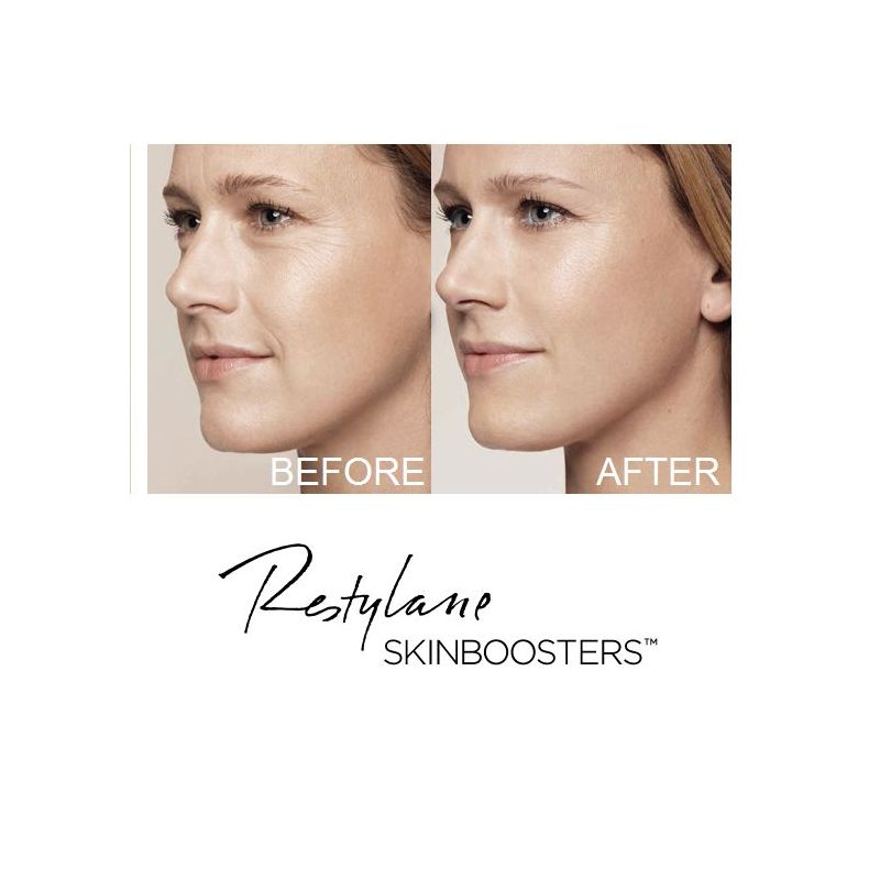 RESTYLANE VITAL LIDO SKINBOOSTER (1x1ml) GALDERMA