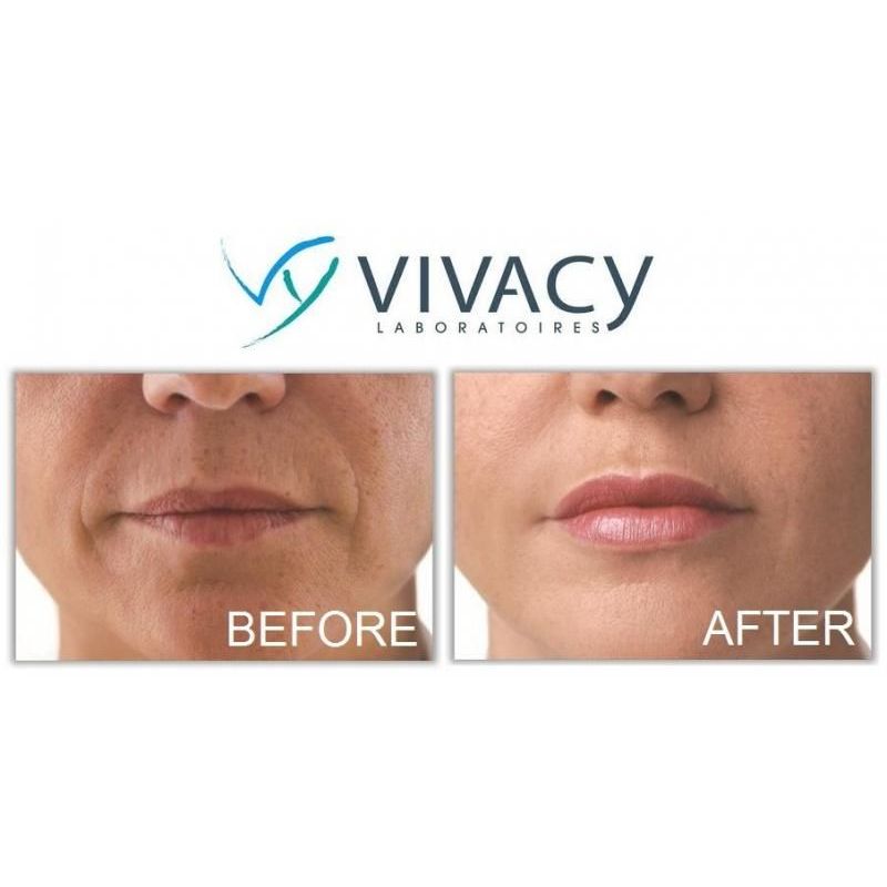 BUY STYLAGE XXL VIVACY in FRANCE | Deep wrinkles. Facial contour