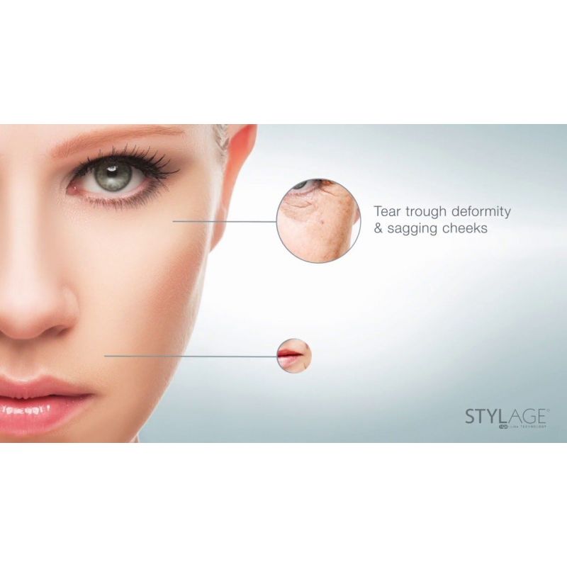 BUY STYLAGE M VIVACY in FRANCE | Medium wrinkles. Lip augmentation