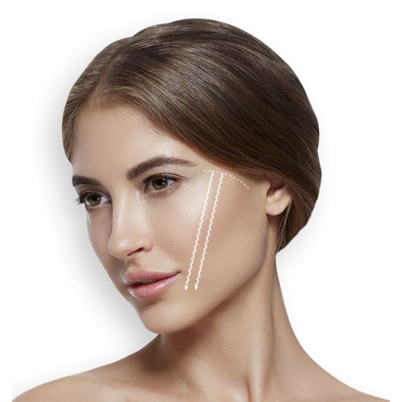 APTOS LIGHT LIFT SPRING METHOD SOFT RESORBABLE