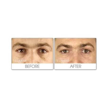 BUY TEOSYAL REDENSITY [II] | Treatment of dark circles under the eyes