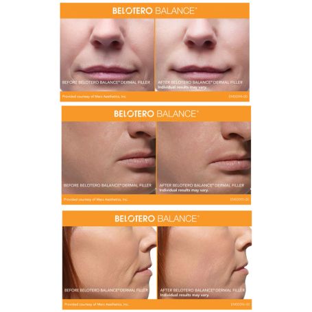 BELOTERO BALANCE LIDO (1x1ml) MERZ AESTHETICS