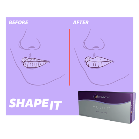 BUY JUVEDERM VOLIFT | Volume for lips, cheeks, cheekbones, temples